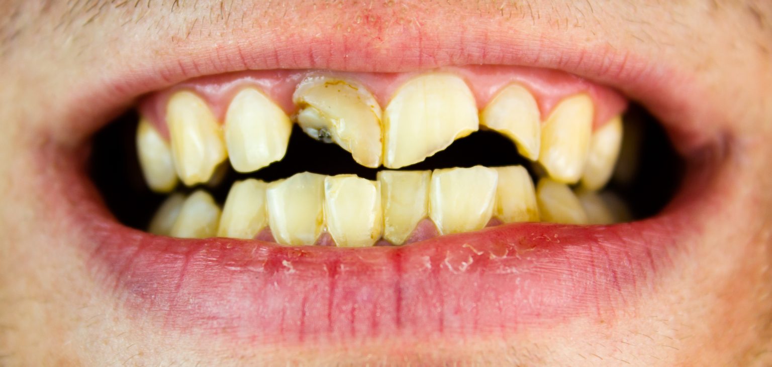 How Can I Fix A Chipped Or Broken Tooth? Repair Options